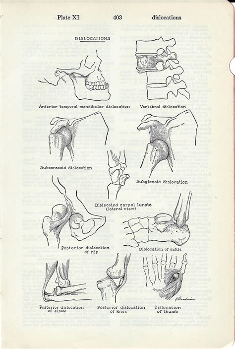 Human Anatomy Dislocation Types Vintage Medical Anatomy Etsy