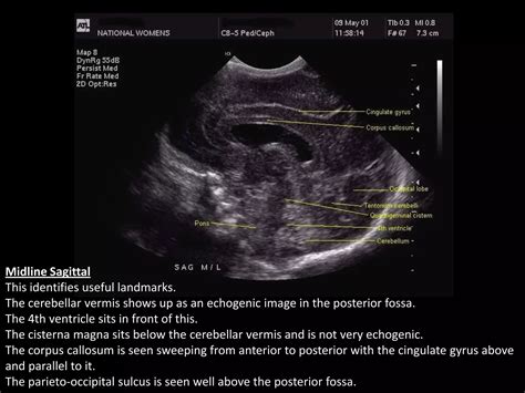 Neurosonogram Dr Padmesh Pptx
