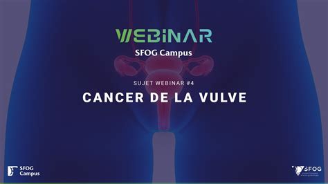 WEBINAR 4 CANCER DE LA VULVE SFOG CAMPUS YouTube