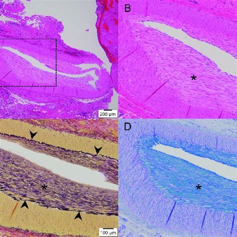 Histopathological Pictures Of Resected Superficial Temporal Artery A