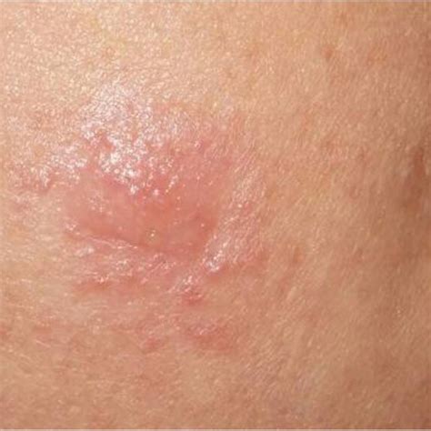 An Example Of A Positive Patch Test Result Download Scientific