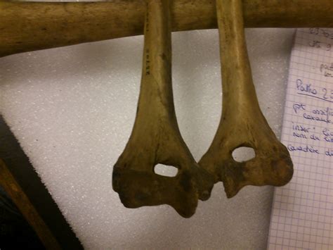 Is This A Type Of Fracture Or Just Septal Aperture Researchgate