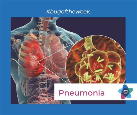 Pneumonia