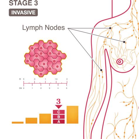 Stage 3 Breast Cancer Overview National Breast Cancer Foundation