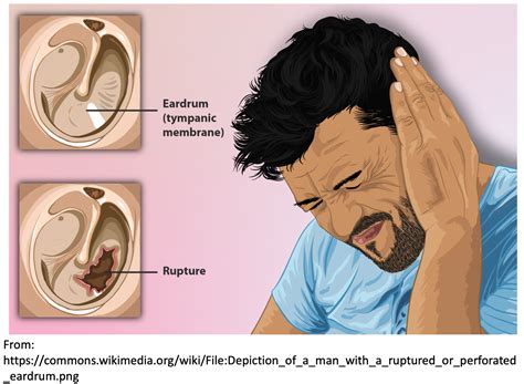 Perforated Eardrum Otitis Media At Joshua Ingram Blog