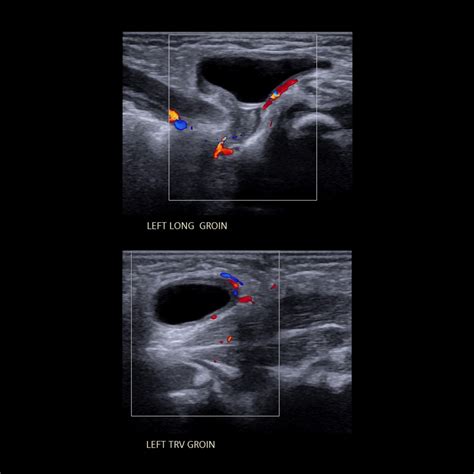 Female Infant With A Bulge In The Left Inguinal Canal Pediatric