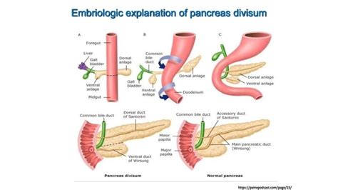Klaus Mönkemüller On Linkedin The Embryologic Explanation Of Pancreas Divisum Dive Deeper Into The…