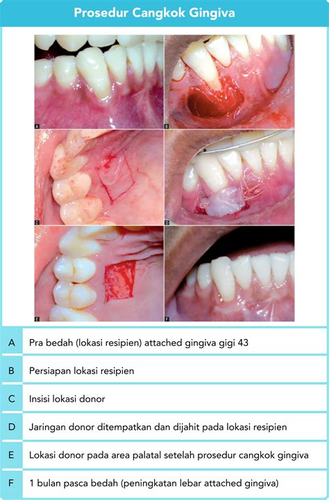 Flap Dan Cangkok Gingiva