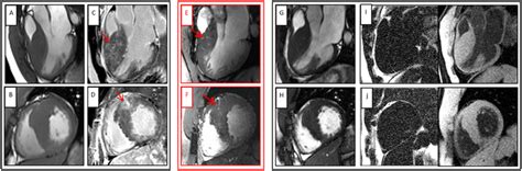 Hcm Patient With Myocardial Crypts In The Anteroseptal Region Upper