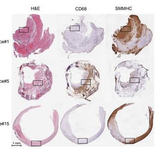 A Carotid Plaque Was Alternately Sectioned To Allow Histological