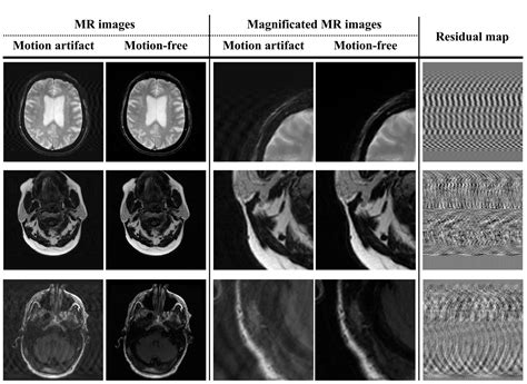 Bioengineering Free Full Text Motion Artifact Reduction Using U Net Model With Three