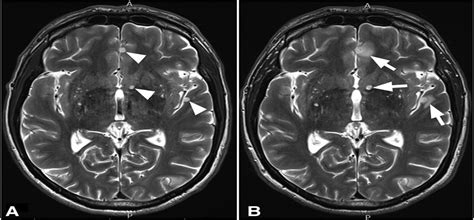 Cryptococcal Meningitis With Immune Reconstitution Inflammat