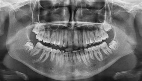 Temporomandibular Disorders In Prospective Orthodontic Patients Dentistry33