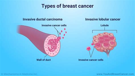 Understanding Breast Cancer Artofit