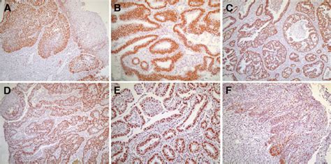 Chek2 Protein Expression Nonmutated Squamous Cell Carcinoma In A Download Scientific