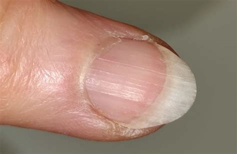 Líneas Horizontales Y Verticales En Las Uñas Dra Lorea Bagazgoitia