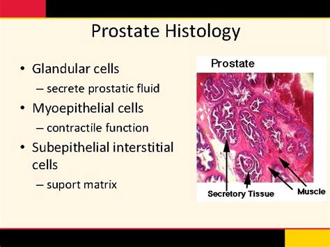 Prostate Embolization New Treatment Option For Bph Howard
