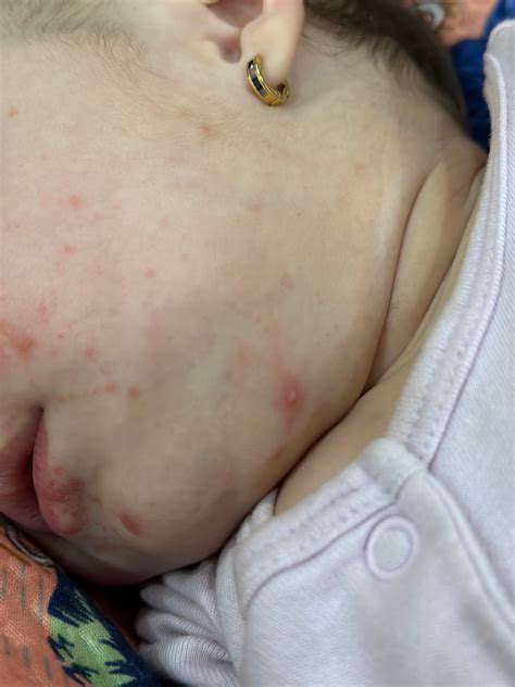 اول شي ارتفعت حرارتها بعدها صار عدها حبوب داخل الفك وماتقدر الطبي