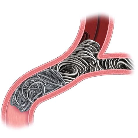 Lp Coil System Detachable Neuro Embolization Coil System Penumbra Inc