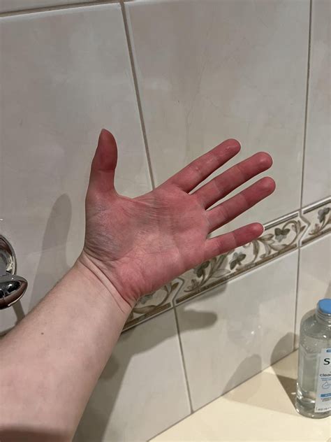 Gp Diagnosed R Erythromelalgia