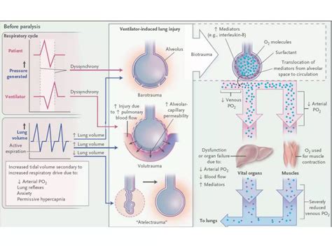 The Use Of Neuromuscular Blocking Agents In Patients With Ards Copy Ppt
