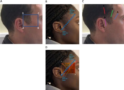 Temporal Artery Biopsy Time For A Rethink On Training Pmc