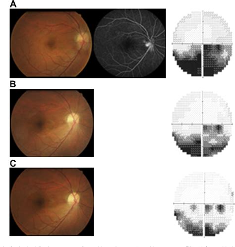 Table 3 From Intravitreal Injection Of Triamcinolone Acetonide In Nonarteritic Anterior Ischemic