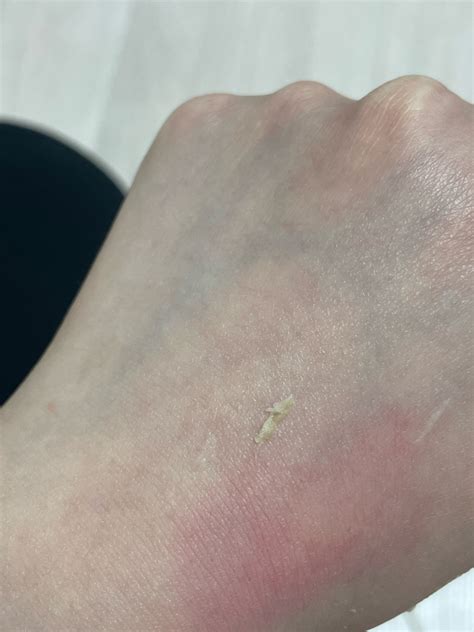 시술수술 질문 바비코 하이코 필러 강남언니 1등 성형수술and피부시술 정보앱