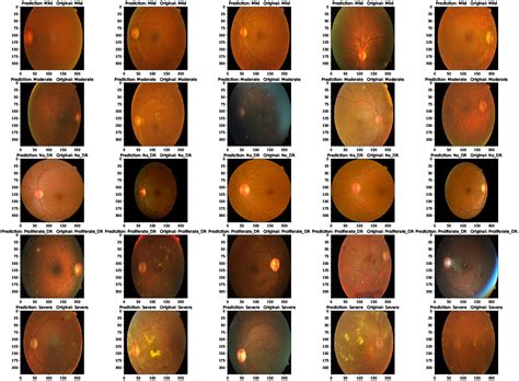 Frontiers A Hybrid Neural Network Approach For Classifying Diabetic Retinopathy Subtypes
