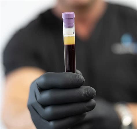 Prf Platelet Rich Fibrin In St Catharines And Niagara