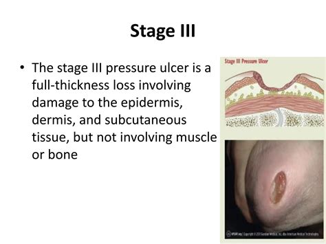 Pressure Ulcers A Decubitus Ulcer Stages Of Bedsore Pdf