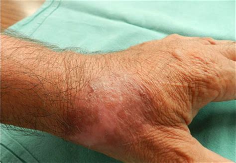 Criptococosis Cutánea Primaria Revista Argentina De Dermatología