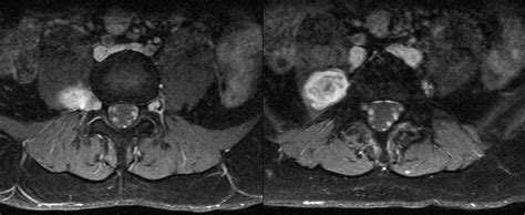 Neurofibromatosis Type Ii