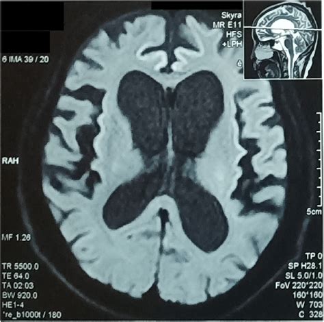 Bilateral Prefrontal Cortex Atrophy And Insular Cortex Atrophy