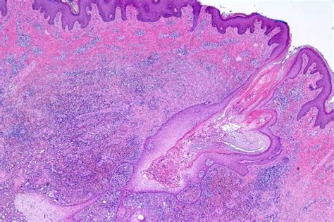 Race Ethnicity And Sex In Hidradenitis Suppurativa
