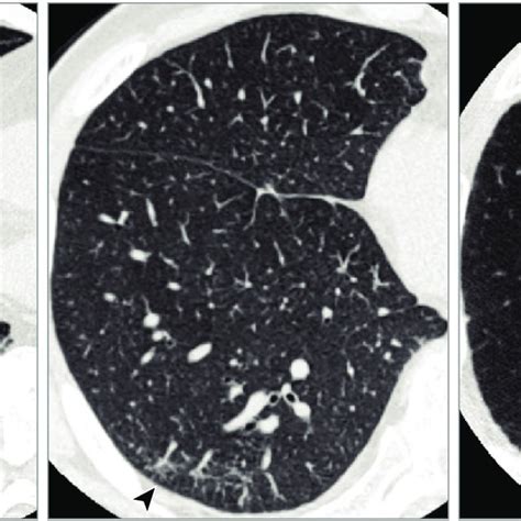 Pdf Association Of Preexisting Interstitial Lung Abnormalities With