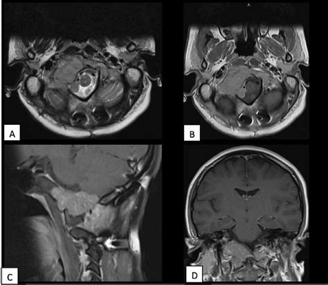 Axial T2 Magnetic Resonance Imaging Showing Large Hypointense