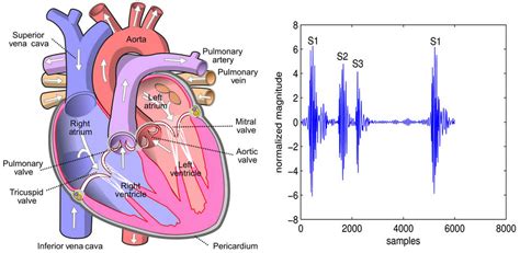 Third Heart Sound Third Heart Sound Causes 60 Off