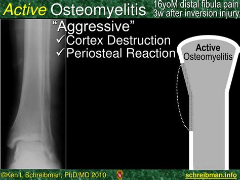 Ppt Osteomyelitis Powerpoint Presentation Free Download Id495462