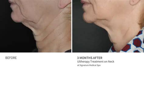 Ultherapy Treatment On Neck Signature Medical Spa