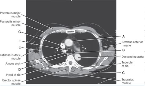 Axial Slice Of Chest Diagram Quizlet