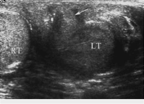 Figure 2 From Isolated Unilateral Testicular Tuberculosis In A Young