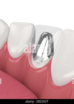 D Render Of Lower Jaw With Cast Post And Core Tooth Restoration Over White Background Stock