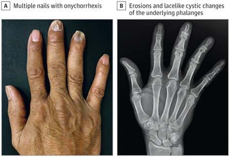 Nail Sarcoidosis Dermatology Jama Dermatology Jama Network
