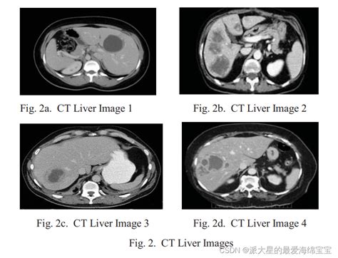 8论文学习liver Tumor Segmentation And Classification A Systematic Reviewthe Liver Tumor