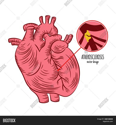 Atherosclerosis Vector And Photo Free Trial Bigstock