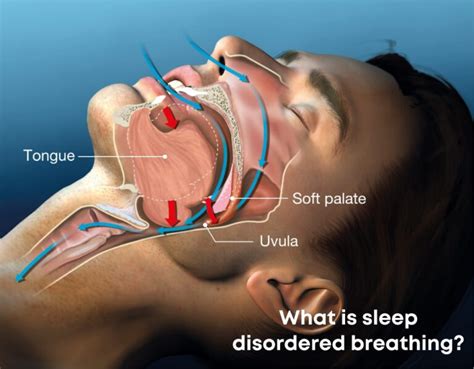 Sleep Disordered Breathing Causes And Treatment Options
