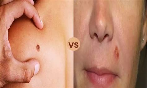 Between Keratoacanthoma And Squamous Cell Carcinoma Top 14 Difference