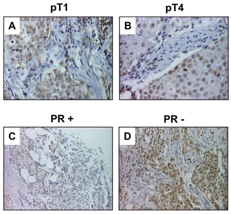 Representative Tissue Microarray Staining Results Illustrating Yb 1 Download Scientific Diagram