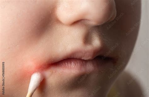 Treatment With Ointment For A Dermatological Disease In The Corners Of The Mouth And Lips Of A